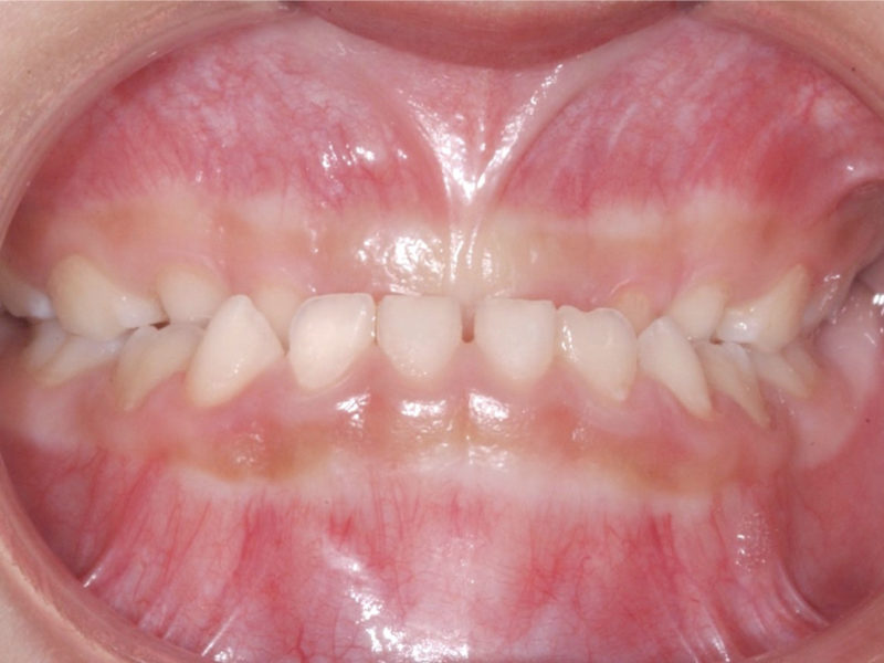 Tratamiento de Progenies - LLACA ortodoncia Oviedo