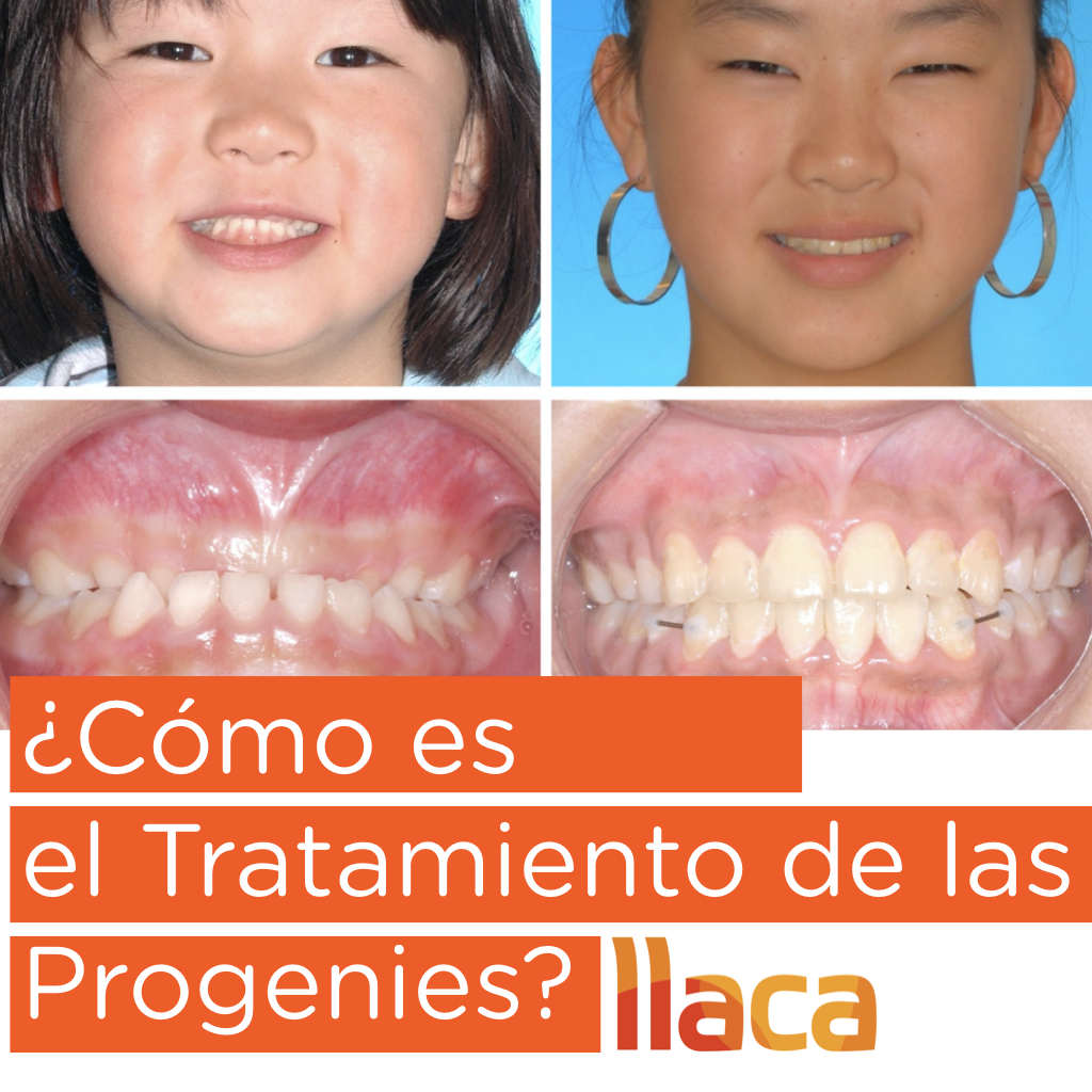 Tratamiento de Progenies | Llaca Ortodoncia Oviedo