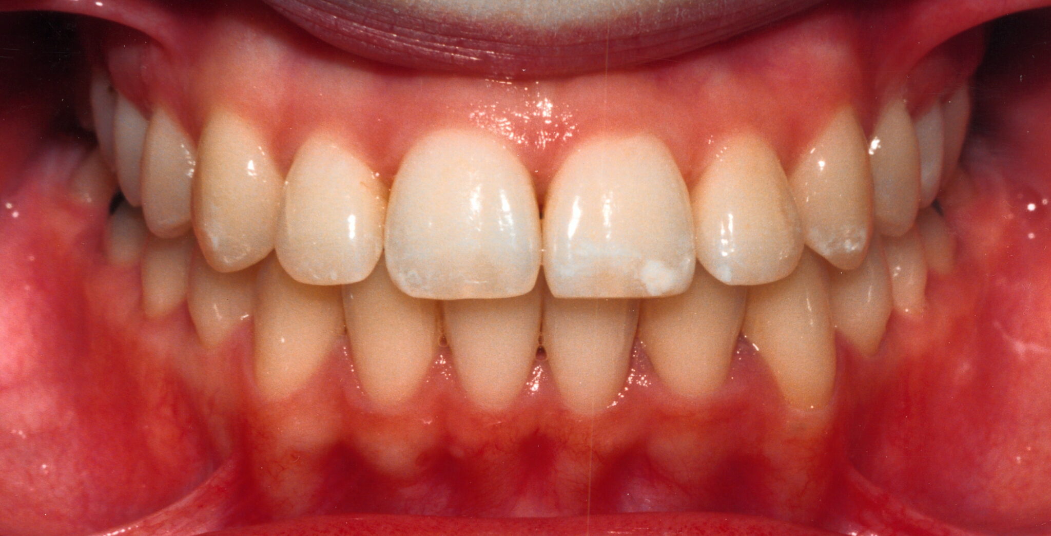 Mordida Cruzada | Llaca Ortodoncia Oviedo