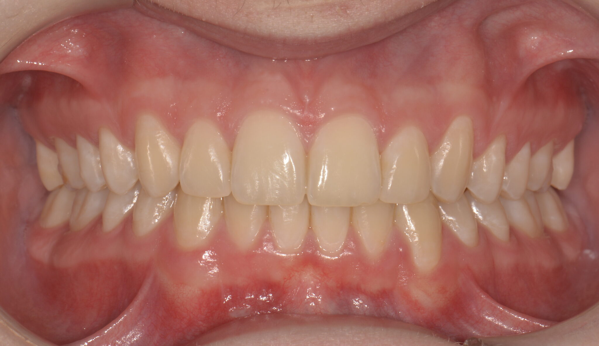 Sobremordida | Llaca Ortodoncia Oviedo