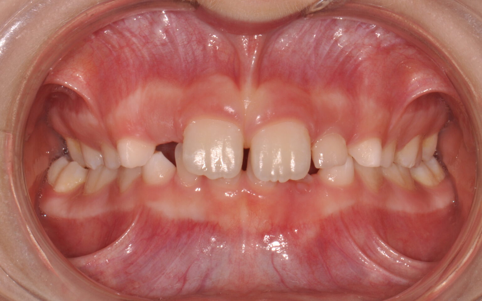 Sobremordida | Llaca Ortodoncia Oviedo