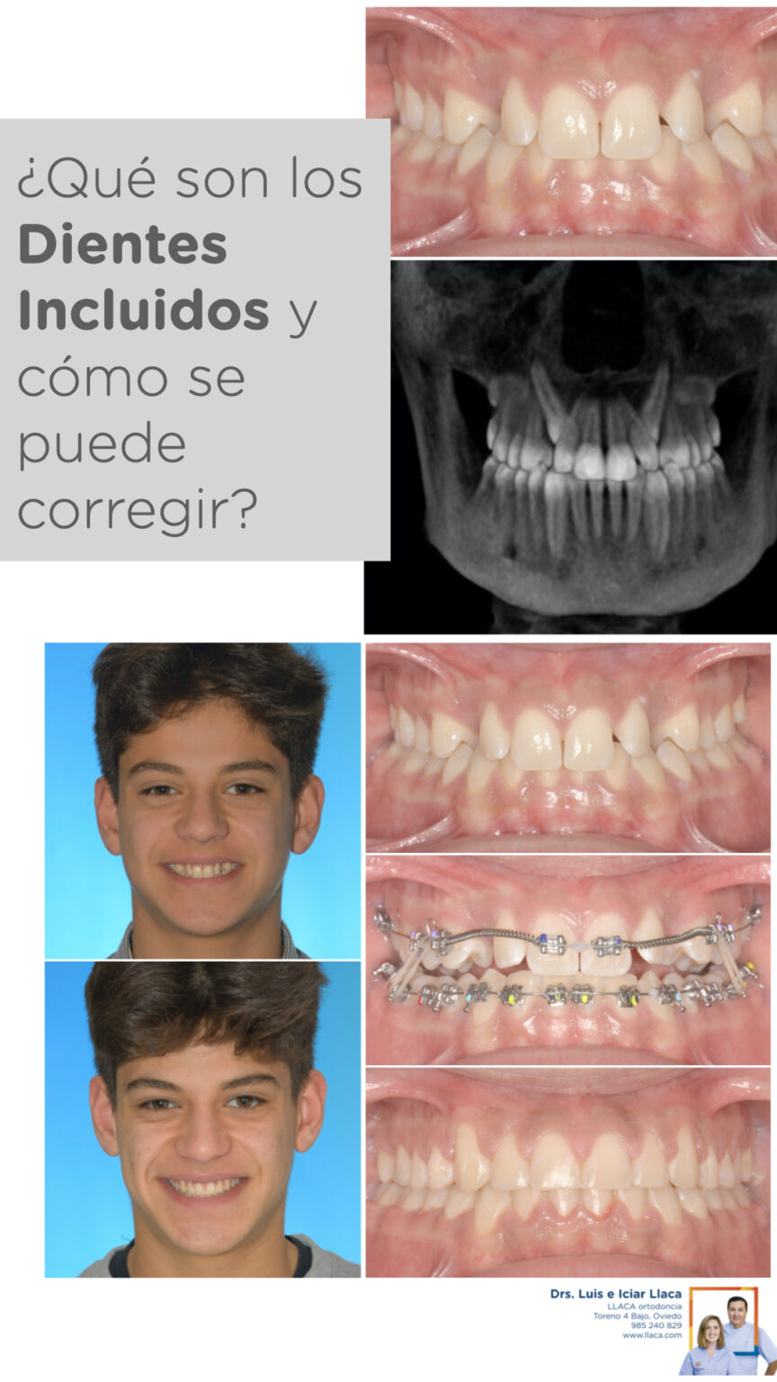 Dientes Incluidos o Impactados | Llaca Ortodoncia Oviedo