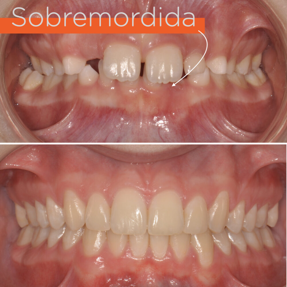 Sobremordida | Llaca Ortodoncia Oviedo
